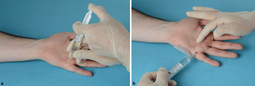 Wide-awake-Technik in der Handchirurgie anhand von Anwendungsbeispielen ...