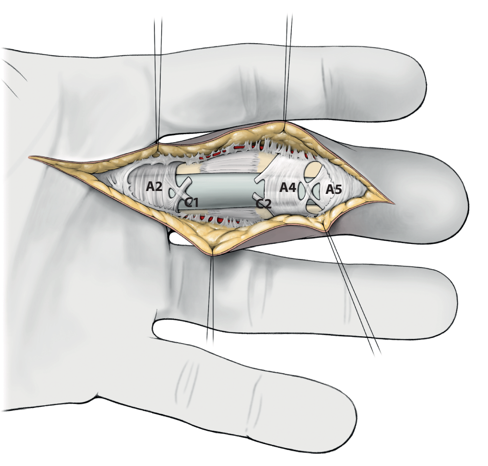 Chirurgische Behandlung von Bissverletzungen | SpringerLink