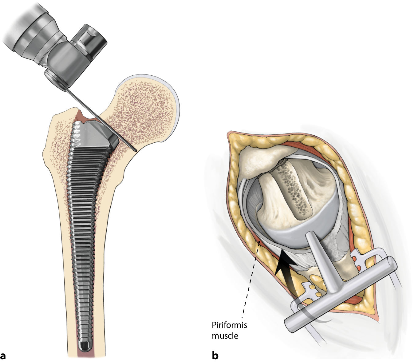 Supercapsular percutaneously assisted (SuperPath) approach in total hip ...