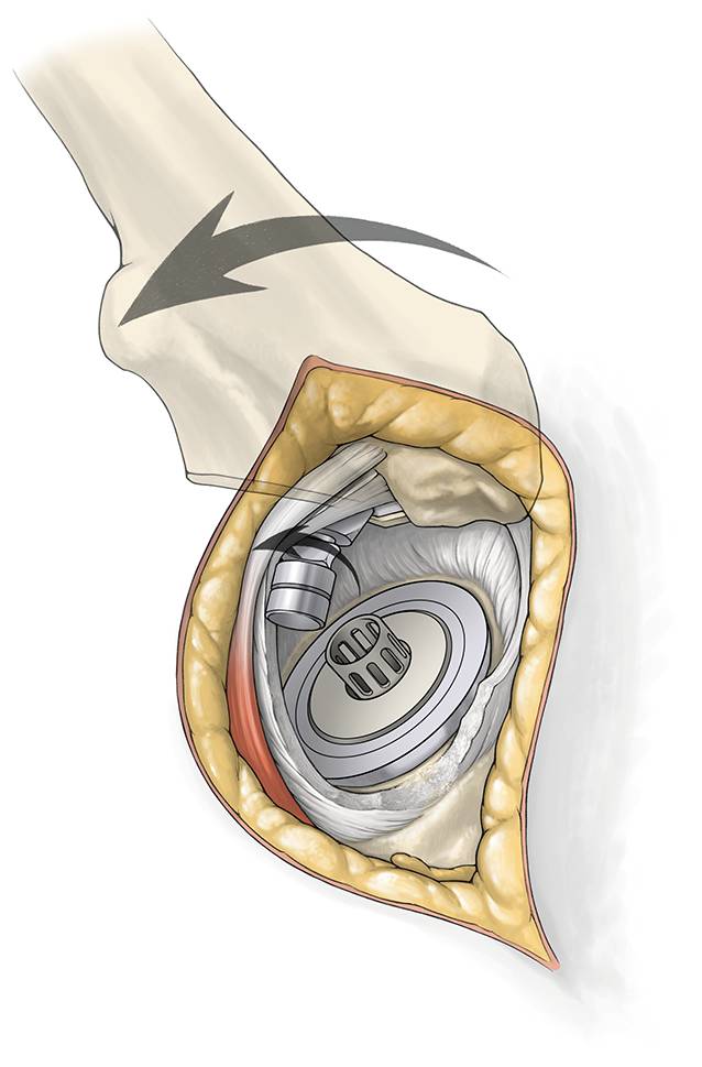 Supercapsular percutaneously assisted (SuperPath) approach in total hip ...
