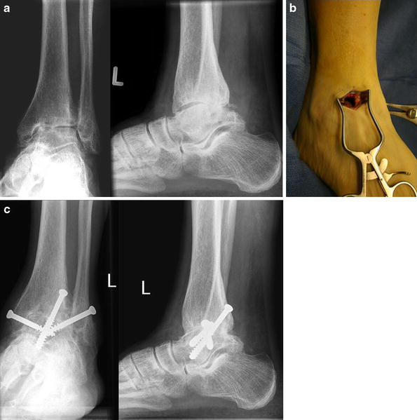Treatment of ankle osteoarthritis: arthrodesis versus total ankle ...