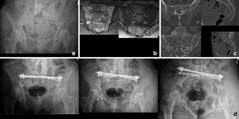 Fragility fractures of the sacrum: how to identify and when to treat ...