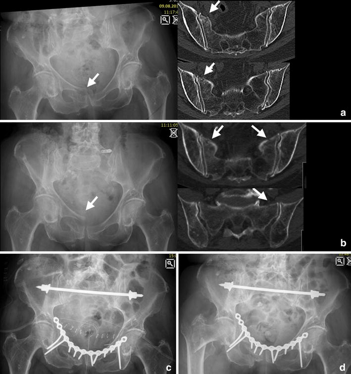 Fragility fractures of the sacrum: how to identify and when to treat ...