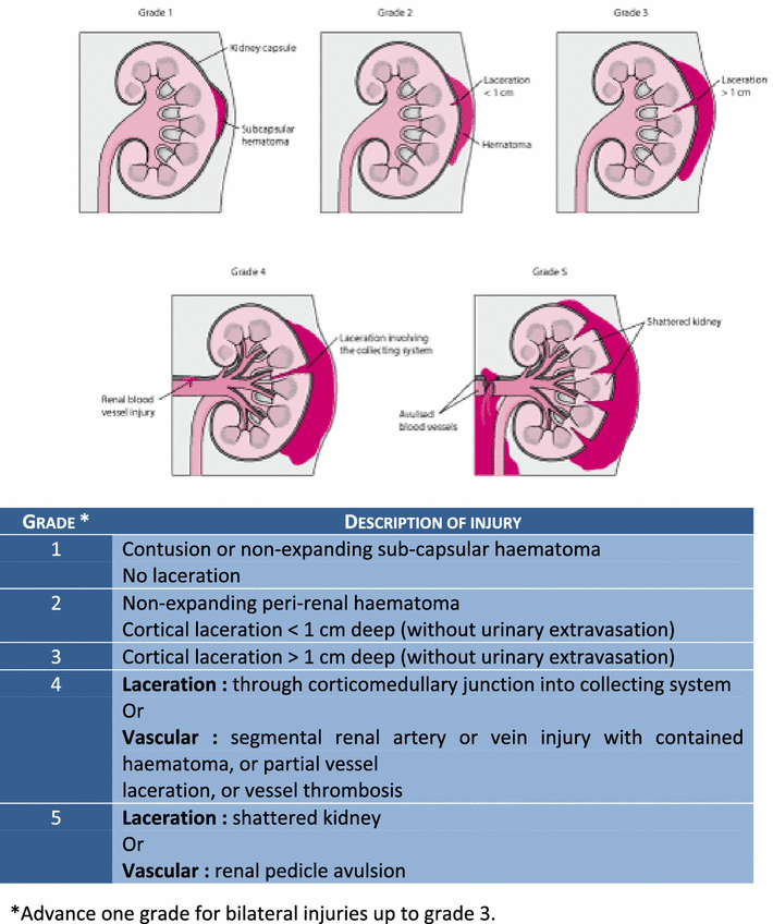 Grade IV renal trauma management. A revision of the AAST renal injury ...