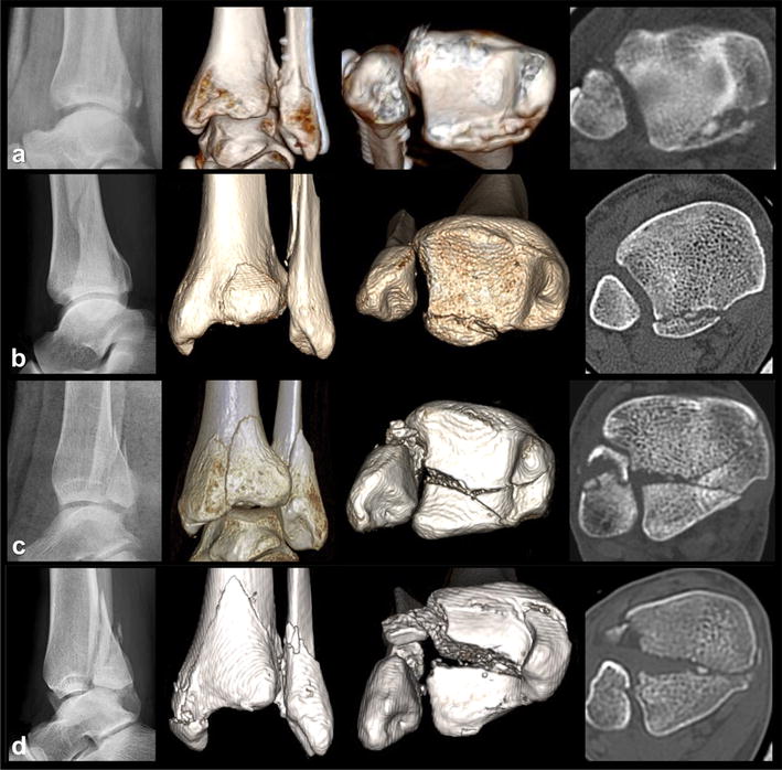Posterior malleolar fractures of the ankle | SpringerLink