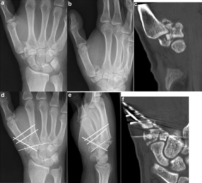Uncommon carpal fractures | SpringerLink