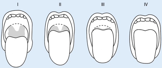 S1 guidelines on airway management | SpringerLink