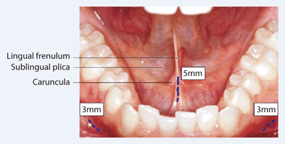 Transorale endoskopische Thyreoidektomie | SpringerLink