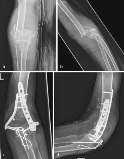 Frakturen des Ellenbogengelenkes | SpringerLink