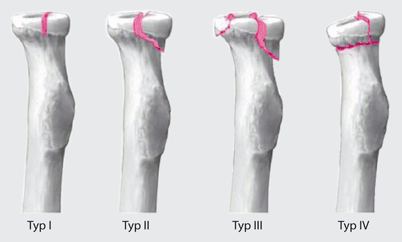 Frakturen des Ellenbogengelenkes | SpringerLink