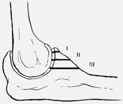 Frakturen des Ellenbogengelenkes | SpringerLink