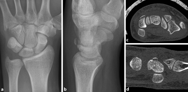 Frakturen der Handwurzelkno﻿chen | SpringerLink
