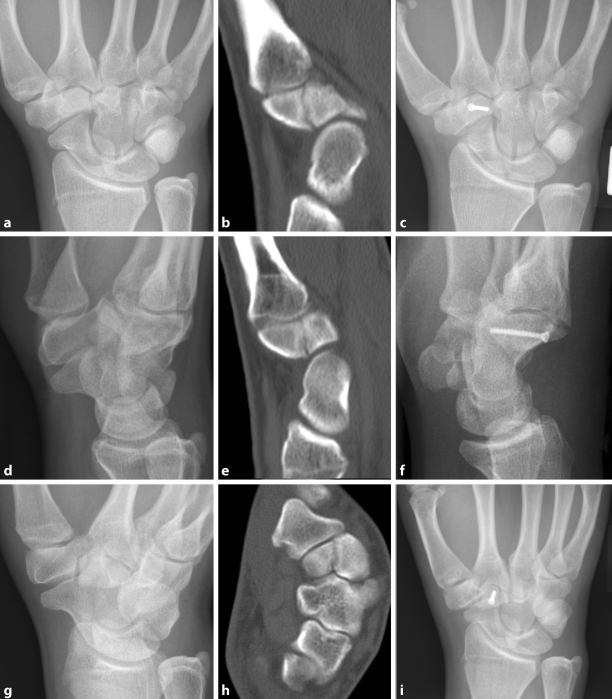 Frakturen der Handwurzelkno﻿chen | SpringerLink