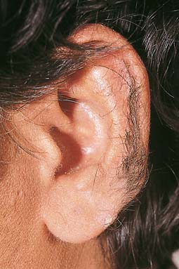 Hypertrichose | SpringerLink