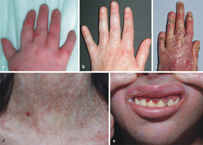 Kindler-Syndrom | SpringerLink