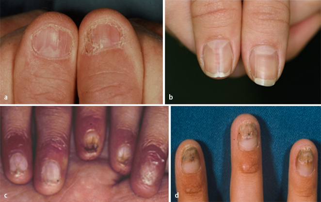 Anomalien der Nägel und Zähne als Schlüssel für die Diagnose von ...