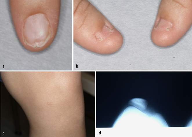 Anomalien der Nägel und Zähne als Schlüssel für die Diagnose von ...