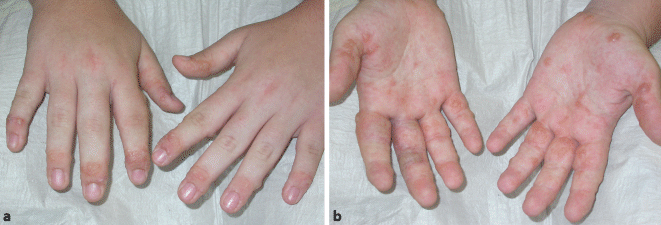 Dermatophytid | SpringerLink