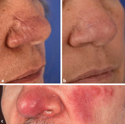 Sarkoidose | SpringerLink