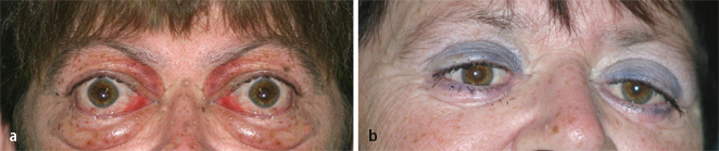 Endokrine Orbitopathie | SpringerLink