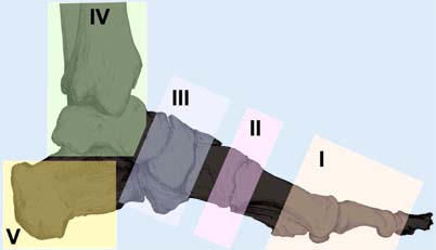 Charcot-Fuß | SpringerLink