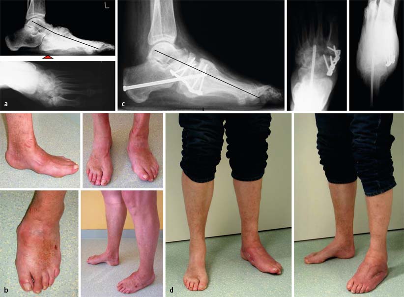 Charcot Fuß Versorgung , Diabetischer Fuß: Diagnostik und Behandlung – KDSK