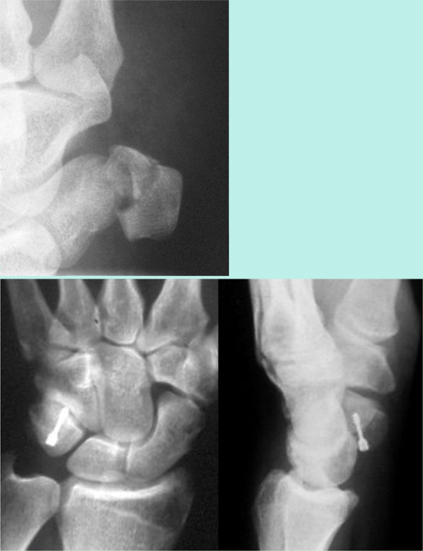Behandlung von Handwurzelfrakturen | SpringerLink