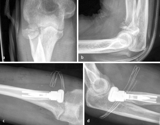 Endoprothetischer Ersatz des radialen Pfeilers nach Trauma | SpringerLink
