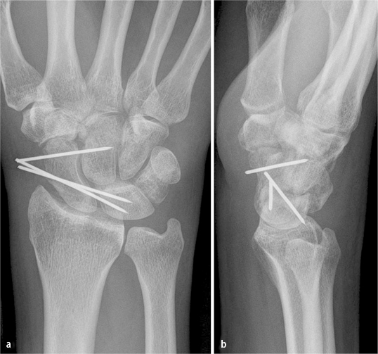 Diagnostik und Therapie von perilunären Luxationen und ...