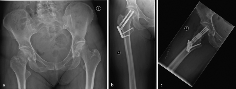 Schenkelhalsfraktur | SpringerLink