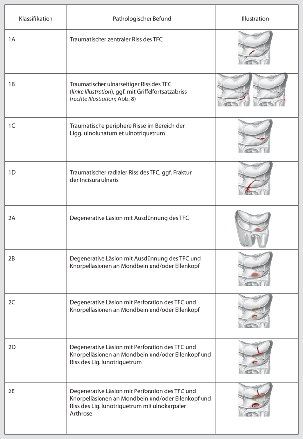 Instabilität des distalen Radioulnargelenks | SpringerLink