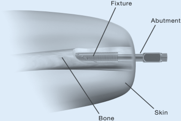 Osseointegrated prostheses for rehabilitation following amputation ...