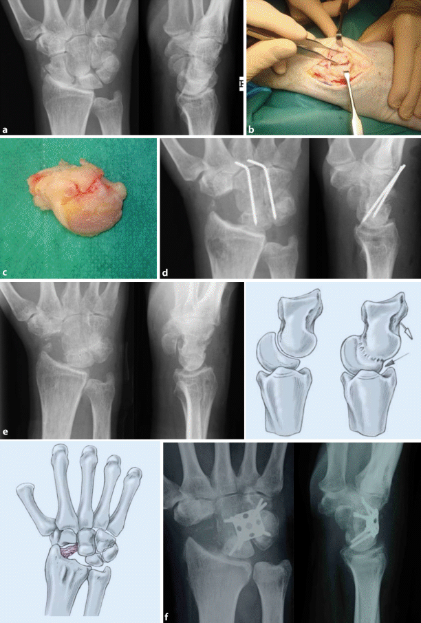 (Teil‑)Arthrodesen am Handgelenk | SpringerLink