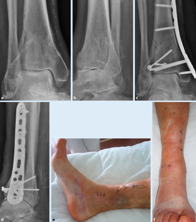 Pilon-tibiale-Frakturen | SpringerLink
