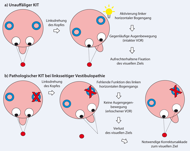 Videobasierter Kopfimpulstest | SpringerLink