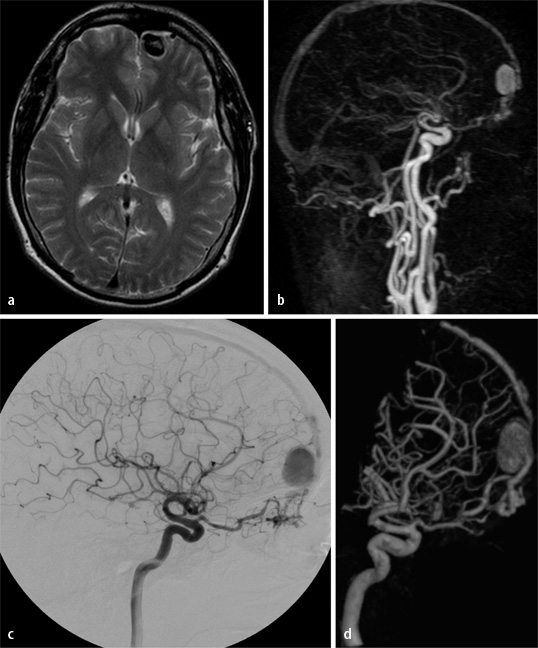 Diagnostik und Therapie duraler arteriovenöser Fisteln | SpringerLink