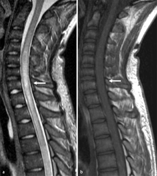 Trauma der Halswirbelsäule | SpringerLink