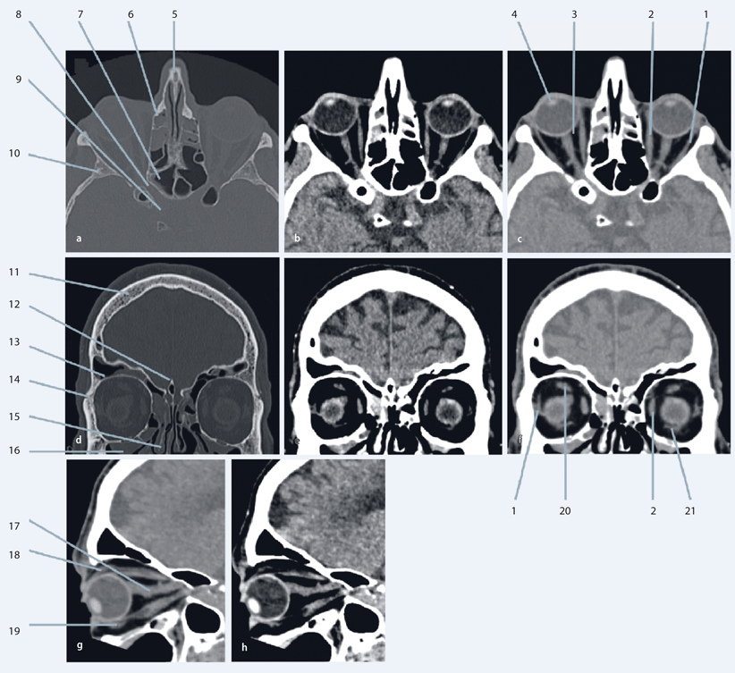 Orbita – Anatomie, Entwicklung und Fehlbildungen | SpringerLink