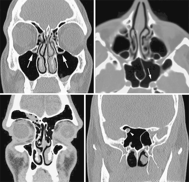 Radiologische Diagnostik der Nasennebenhöhlen | SpringerLink