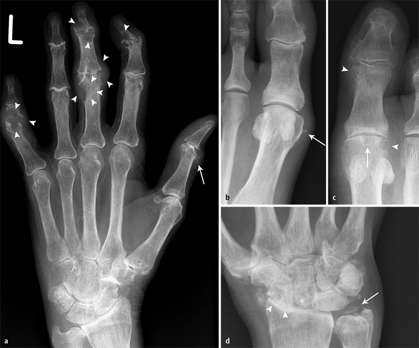 Bildgebung rheumatischer Erkrankungen | SpringerLink