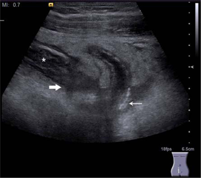 Beeindruckendes Sonogramm einer Appendizitis | SpringerLink