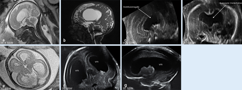 Fetales MRT und Ultraschall der angeborenen ZNS-Fehlbildungen ...