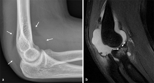 Bildgebung des Ellenbogengelenks mit Fokus MRT | SpringerLink