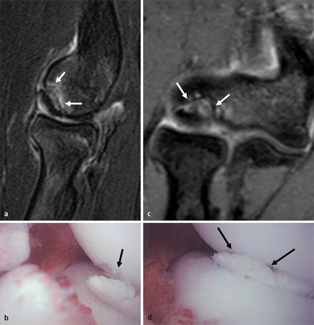 Bildgebung des Ellenbogengelenks mit Fokus MRT | SpringerLink