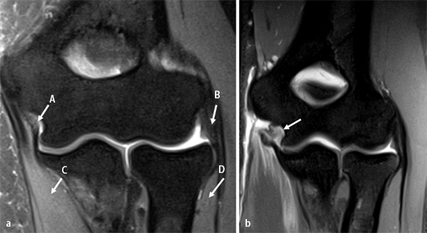 Bildgebung des Ellenbogengelenks mit Fokus MRT | SpringerLink