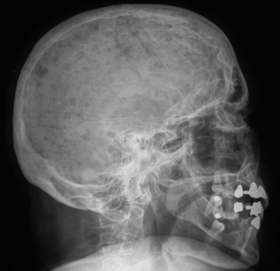 Radiologische Diagnostik des multiplen Myeloms | SpringerLink