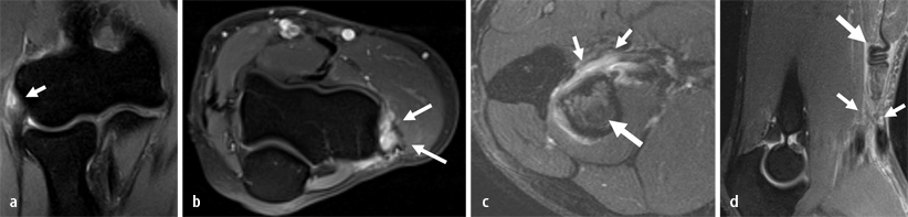 Bildgebung des Ellenbogengelenks mit Fokus MRT | SpringerLink