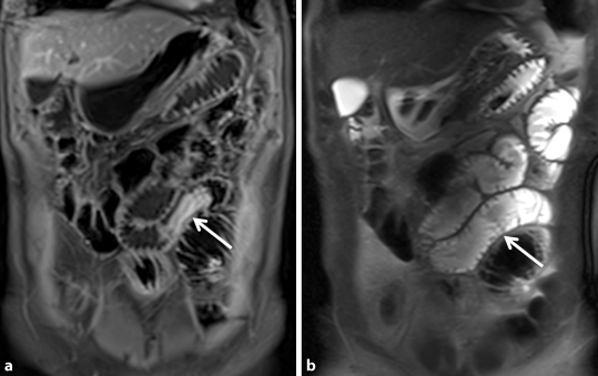 Moderne MRT des Dünndarms | SpringerLink