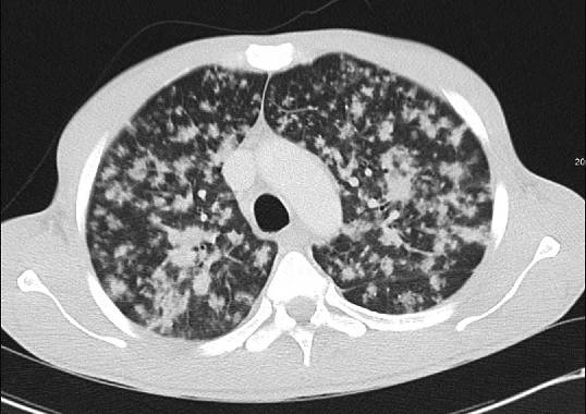 Thorakale Manifestation der Tuberkulose | SpringerLink