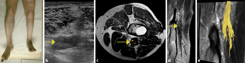 Bildgebung des Plexus lumbosacralis | SpringerLink